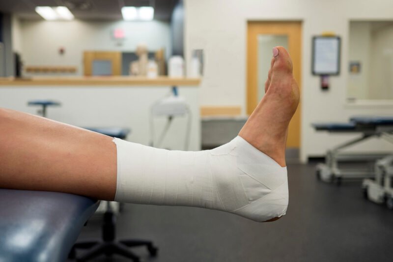Broken Bone or Sprain | How to Tell | Fracture Healing