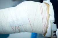 The Link Between Broken Bones and Blood Clots