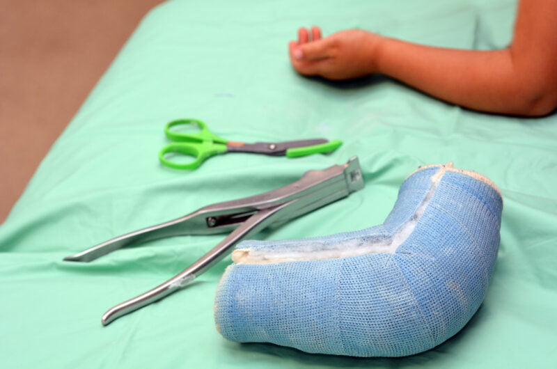 Cast Removal Dos and Don'ts: Transition Back to Normalcy