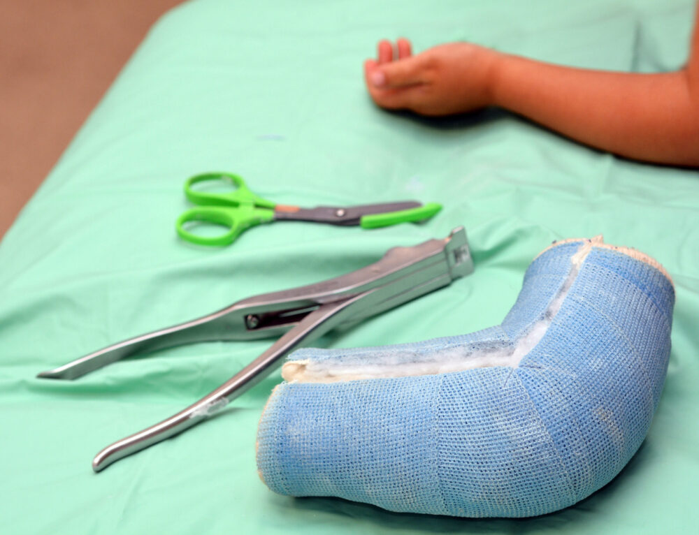 5 Stages of Fracture Healing - Fracture Healing