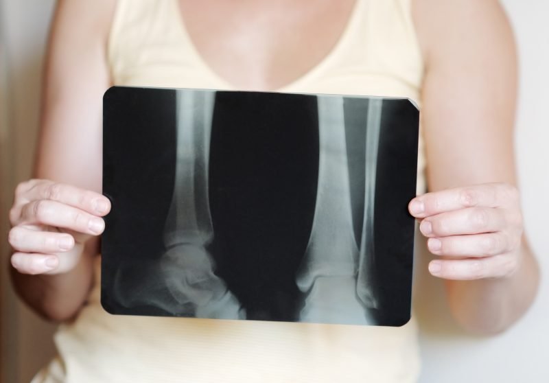 How Fractures Impact Bone Density Over Time
