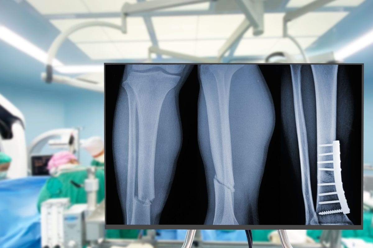 Can Comminuted Fractures Heal Without Surgery? | Fracture Healing
