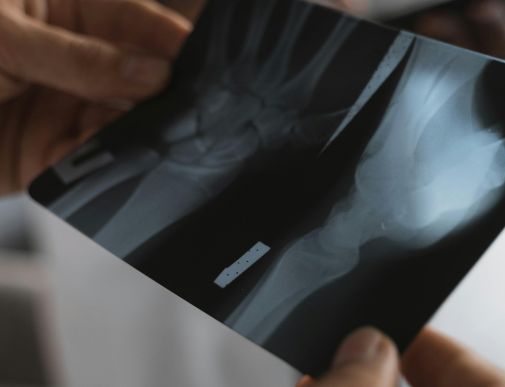 Tibia Fracture Healing Time: What to Expect | Fracture Healing