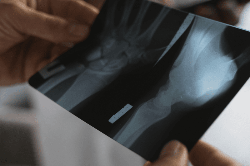 LIPUS for Delayed Union & NonUnion Fractures | Fracture Healing